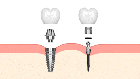 Conventional Implants vs Mini Dental Implants: Key Differences