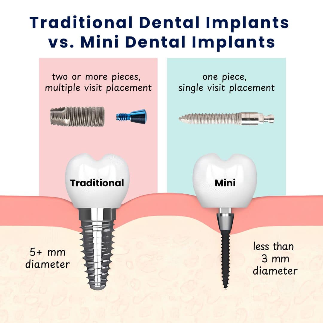 Dental Implants vs. Mini Implants: Which is the Best Solution?