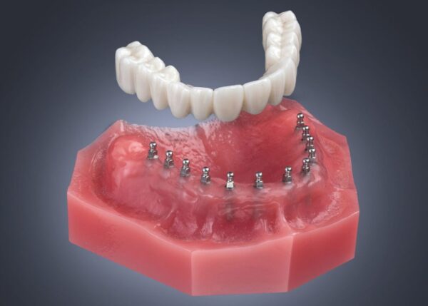 What Are Full-Arch Dental Implants? | Implant Dentures in Foley AL