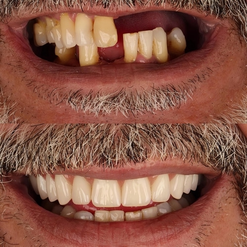 What Are My Options for Replacing Multiple Teeth?