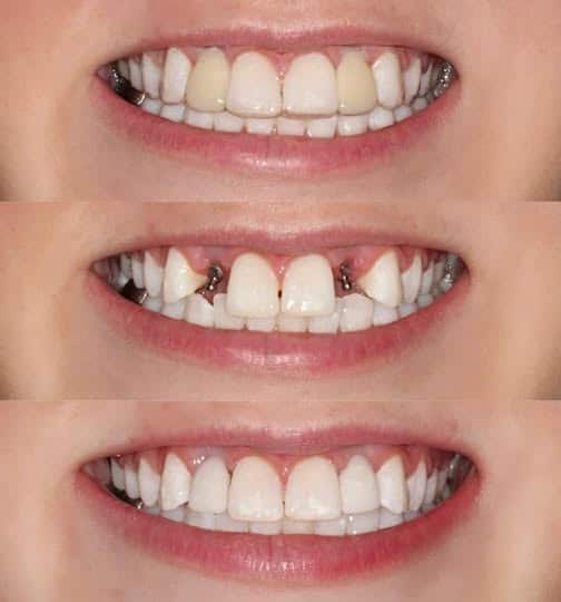 What Is Full-Mouth Rehabilitation? | Implant Dentures in Foley, AL