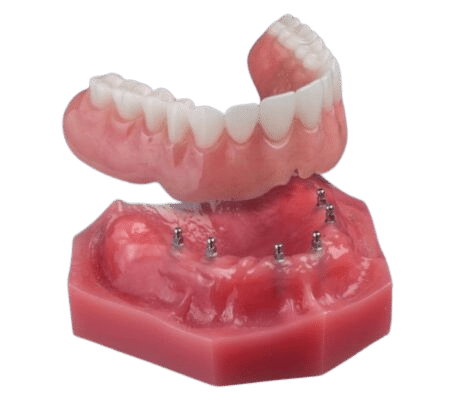 What Is a Semi-Removable Denture? | Dentures in Foley, AL